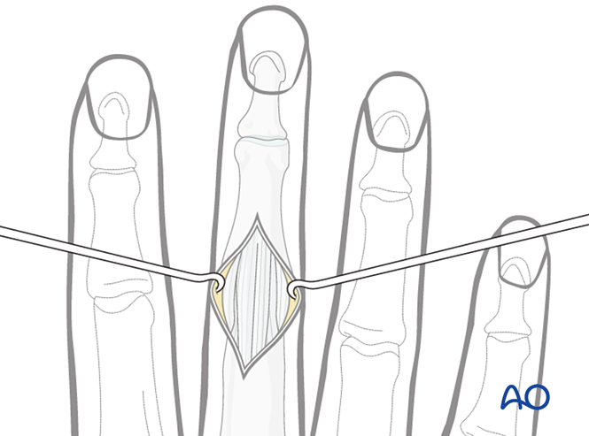 Dorsal approach to the PIP joint