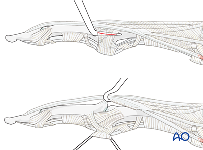 Dorsal approaches to the proximal interphalangeal joint