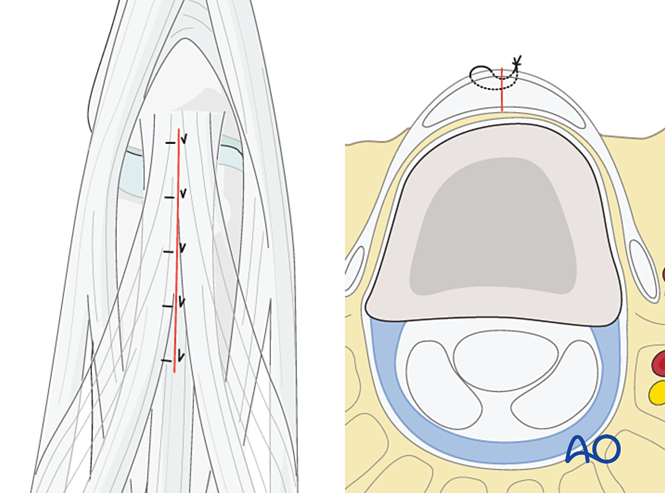 Dorsal approaches to the proximal interphalangeal joint