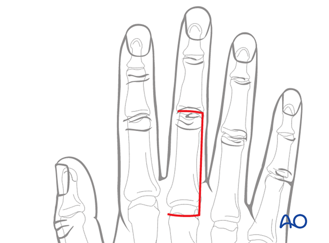 Dorsal approach to the proximal phalanx (after Pratt)