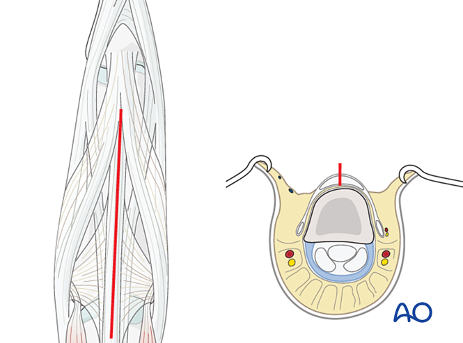 Dorsal approach to the proximal phalanx (after Pratt)