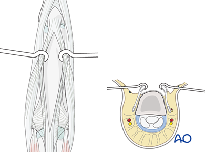 Dorsal approach to the proximal phalanx (after Pratt)