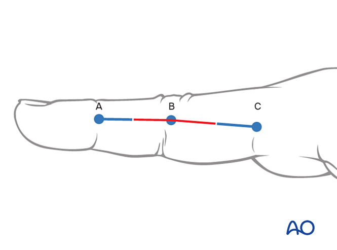 Midaxial (lateral) approach to the proximal interphalangeal joint