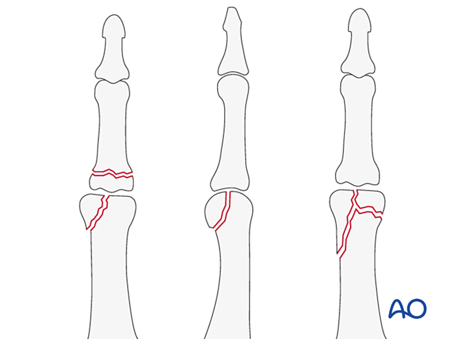 Midaxial (lateral) approach to the proximal interphalangeal joint