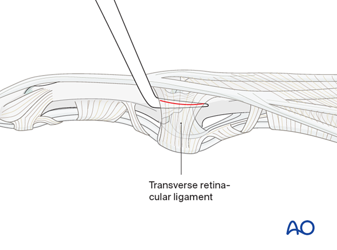 Midaxial (lateral) approach to the proximal interphalangeal joint