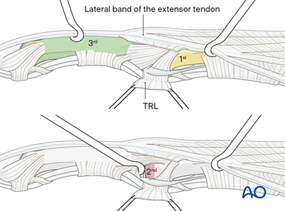 Midaxial (lateral) approach to the proximal interphalangeal joint