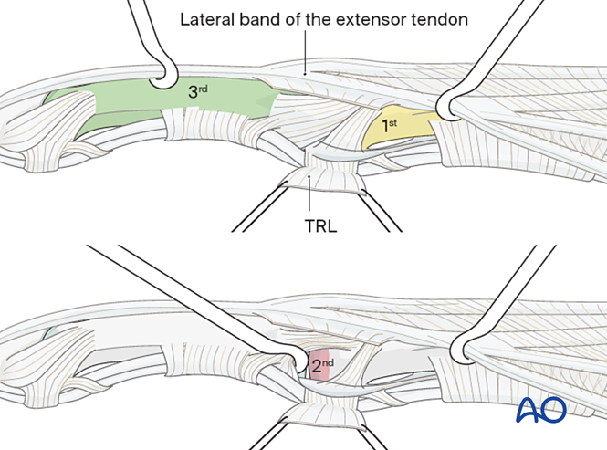 Midaxial (lateral) approach to the proximal interphalangeal joint