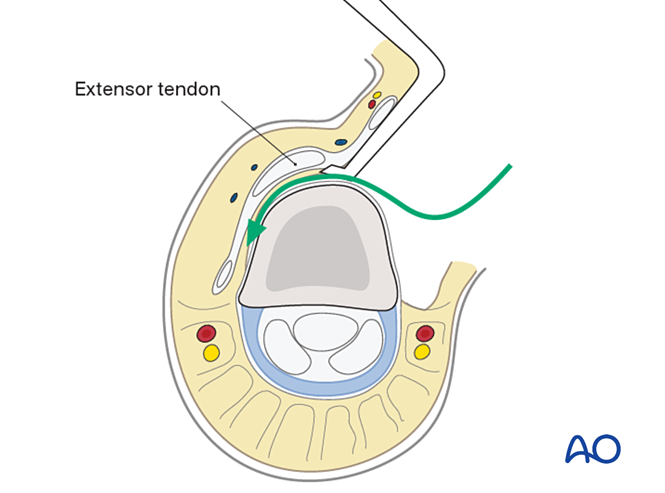 Midaxial (lateral) approach to the proximal phalanx
