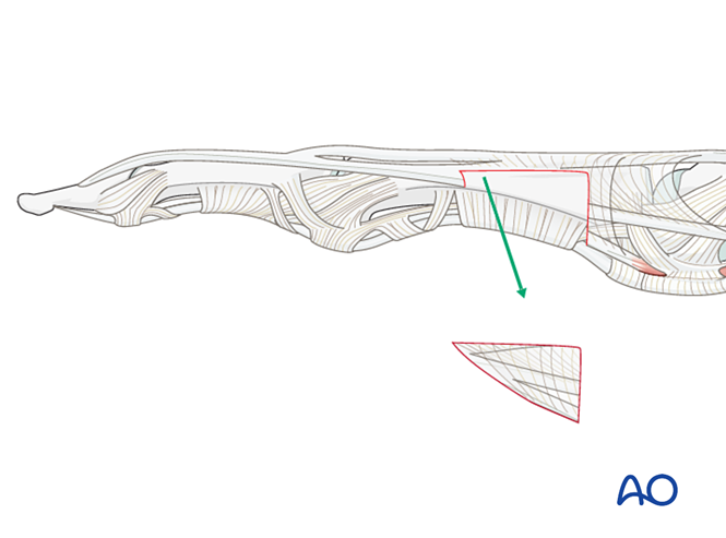 Midaxial (lateral) approach to the proximal phalanx