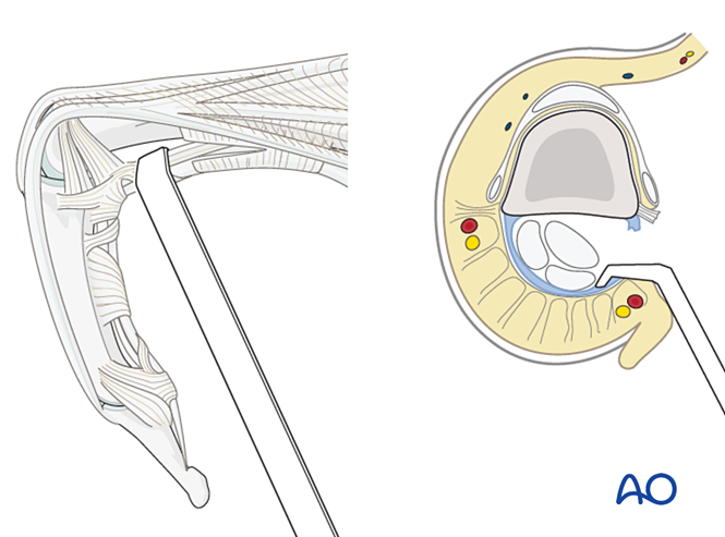 Midaxial (lateral) approach to the proximal phalanx