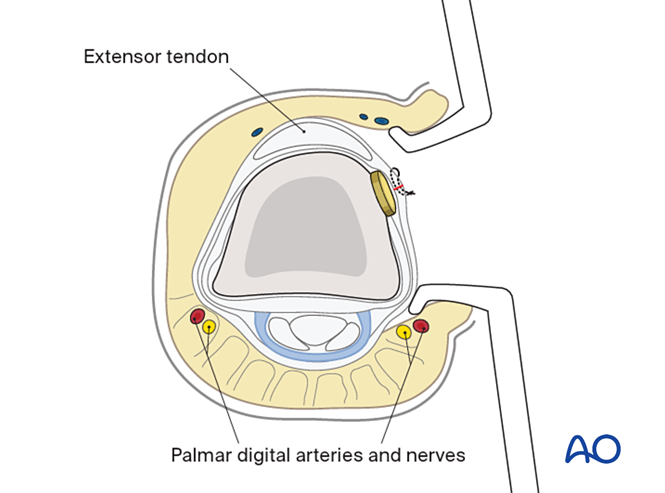 Midaxial (lateral) approach to the proximal phalanx