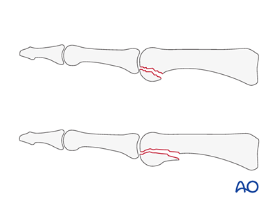 Palmar approach to the proximal interphalangeal joint