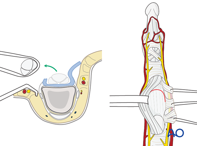 Palmar approach to the proximal interphalangeal joint
