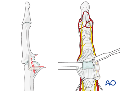 Palmar approach to the proximal interphalangeal joint
