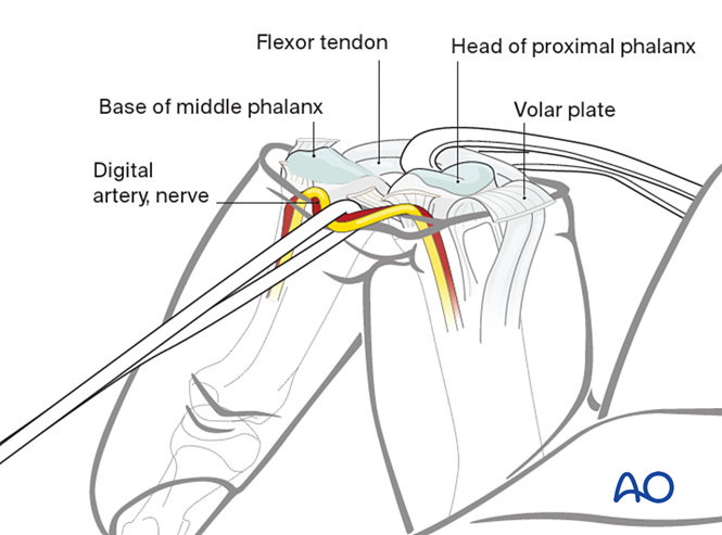 Palmar approach to the proximal interphalangeal joint
