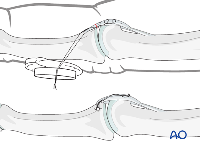 Palmar approach to the proximal interphalangeal joint