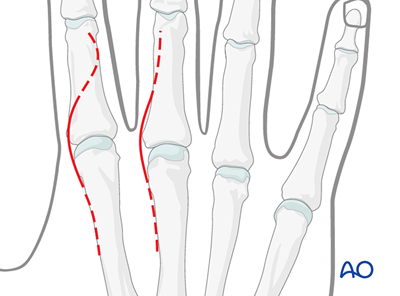 Dorsal approach to the metacarpophalangeal joint