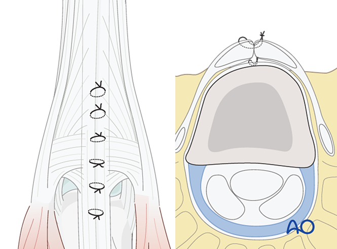 Dorsal approach to the metacarpophalangeal joint