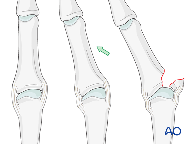 Avulsion at the proximal end segment