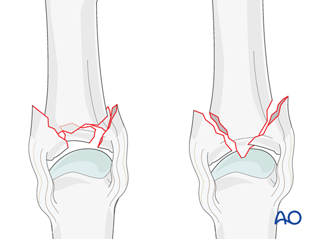 Complete articular fracture of the proximal end segment