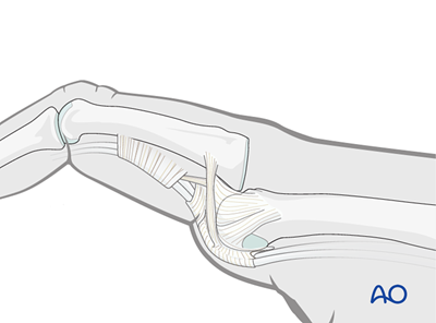 Dislocation of the metacarpophalangeal joint