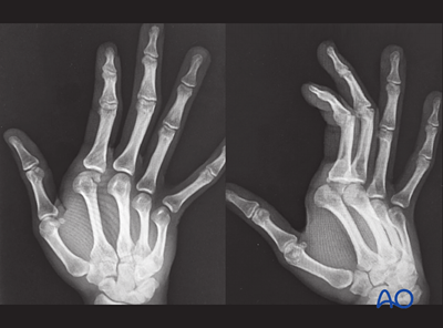 Dislocation and fracture-dislocation of the metacarpophalangeal joint