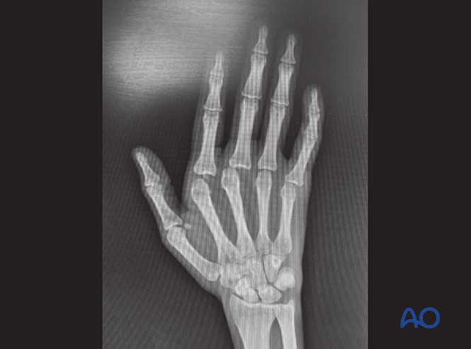 Dislocation and fracture-dislocation of the metacarpophalangeal joint
