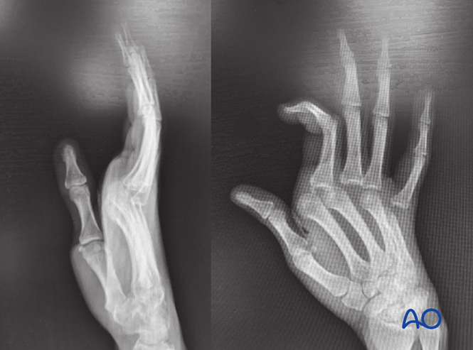 Dislocation and fracture-dislocation of the metacarpophalangeal joint