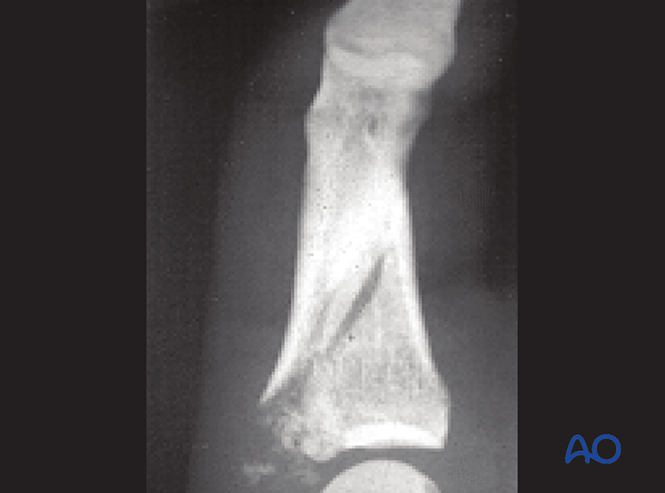 Oblique extraarticular fracture of the proximal end segment