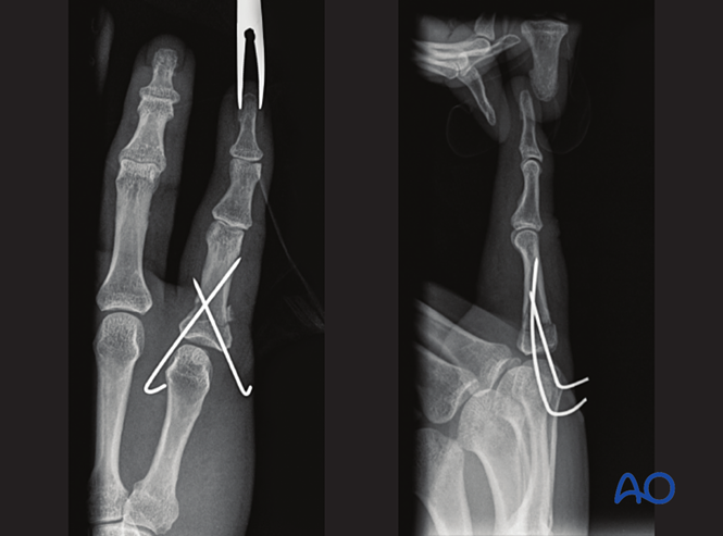 K-wire fixation for Transverse extraarticular fracture of the proximal ...