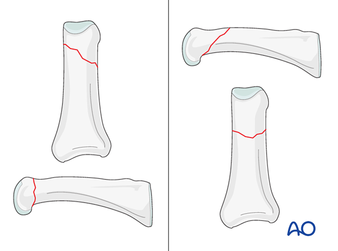 Oblique extraarticular fracture of the distal end segment