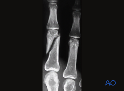 Oblique extraarticular fracture of the distal end segment
