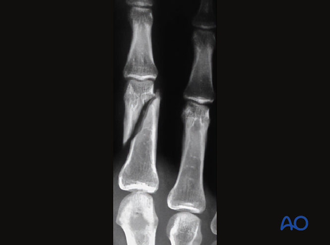 Oblique extraarticular fracture of the distal end segment