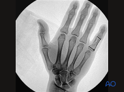 Bridge plating for Wedge/multifragmentary extraarticular fracture of ...