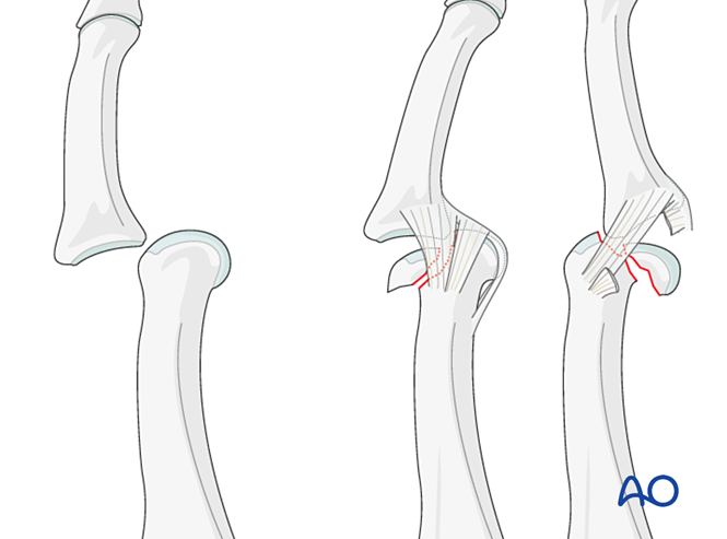 Dislocation and fracture-dislocation of the proximal interphalangeal joint