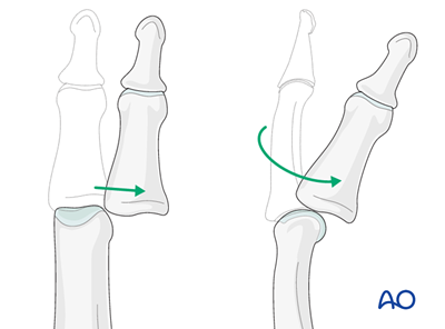 Dislocation and fracture-dislocation of the proximal interphalangeal joint