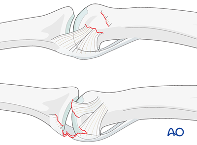 Dislocation and fracture-dislocation of the proximal interphalangeal joint