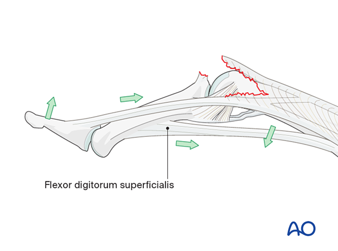 Dislocation and fracture-dislocation of the proximal interphalangeal joint