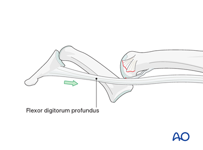 Dislocation and fracture-dislocation of the proximal interphalangeal joint