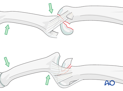 Dislocation and fracture-dislocation of the proximal interphalangeal joint