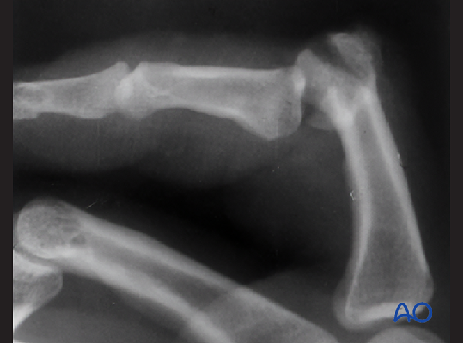 Dislocation and fracture-dislocation of the proximal interphalangeal joint