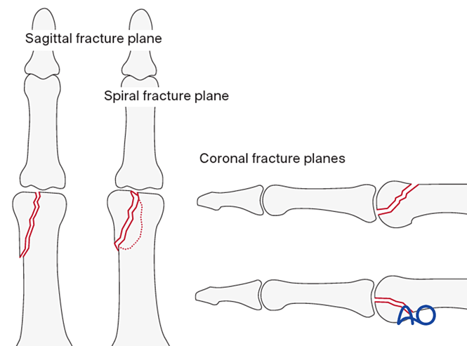 Partial articular fracture of the distal end segment