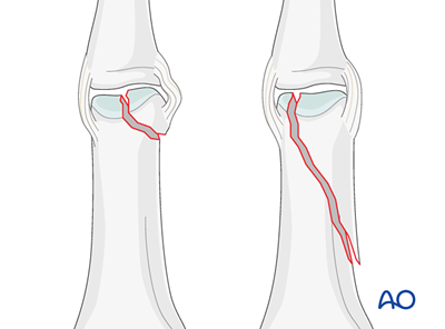 Partial articular fracture of the distal end segment