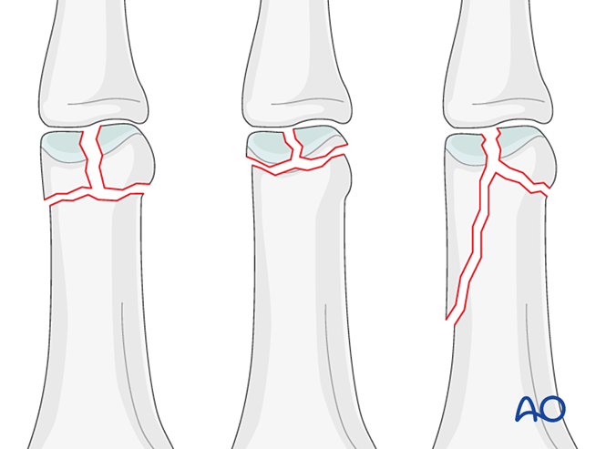 Complete articular fracture of the distal end segment