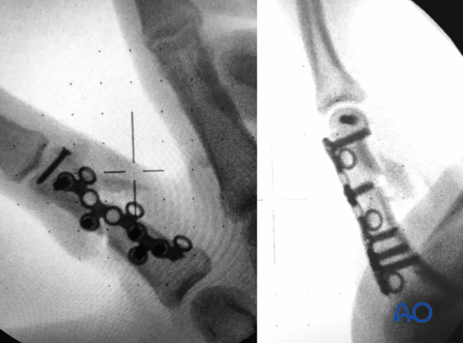 Plating with a dorsal T-plate for Complete articular fracture of the ...