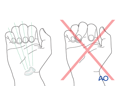 Nonoperative treatment for Dislocation and fracture-dislocation of the ...