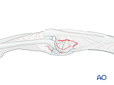 K-wire fixation for Dislocation and fracture-dislocation of the ...