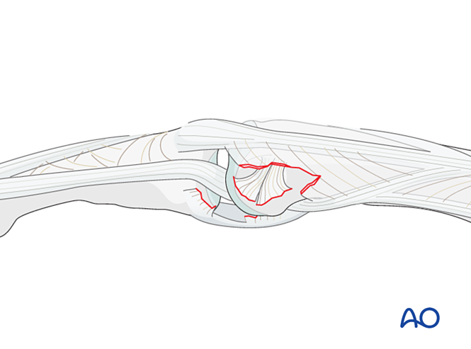 Collateral ligament repair for Dislocation and fracture-dislocation of ...