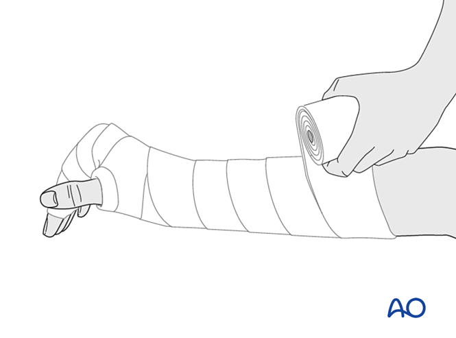 Application Of A Dorsal Splint