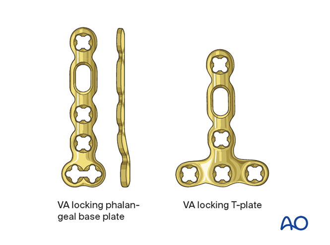 Compression plating with a lateral plate for Transverse extraarticular ...
